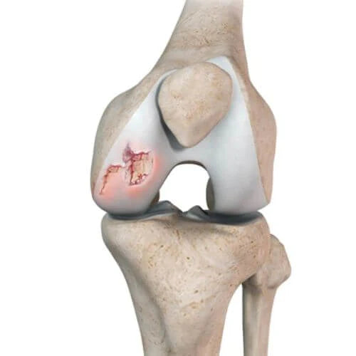 Say Goodbye to Knee Pain: Discover the Techniques to Rebuild Your Knee ...