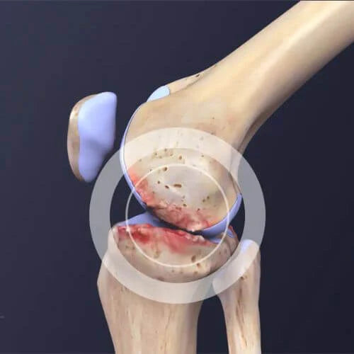 How FlexiKnee Works – mLab